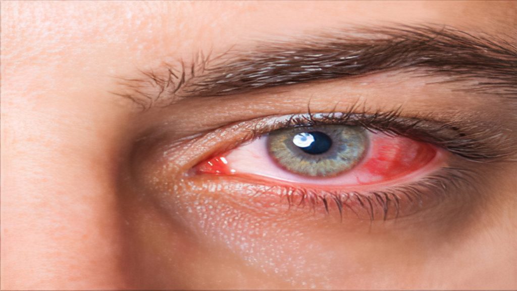 آشنایی با روش های شیمی درمانی سرطان چشم و انواع داروهای آن - کلاه گیس